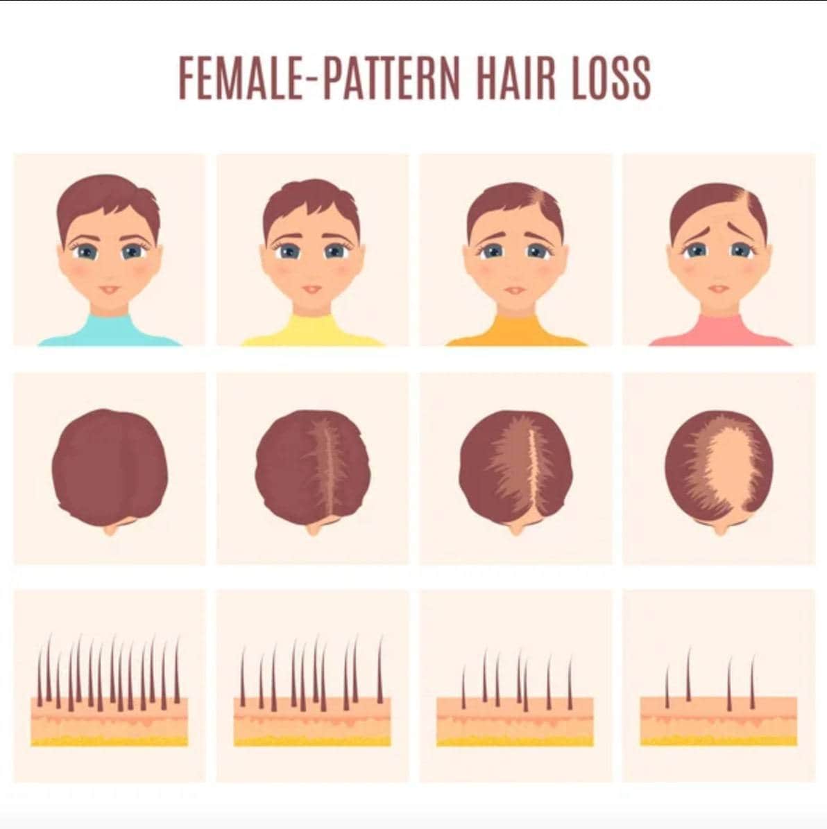 Hair Loss Causes in Women - HTN